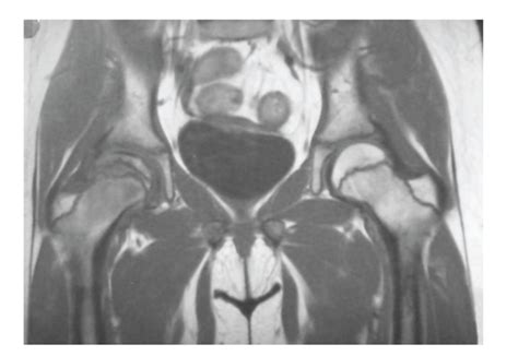 Flattened Right Femoral Head Joint Effusion Enlarged Physes Bone