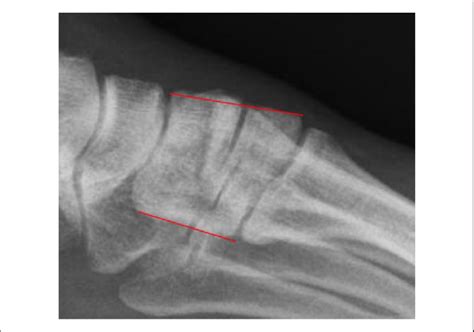 Measurement Of The Dorsal And Plantar Cortex Of The Medial Cuneiform Download Scientific