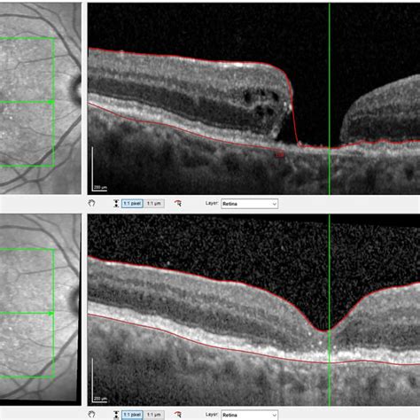 Figure Showing A Merged OCT Scan Of The Rt Eye Of One Of The Operated Download Scientific