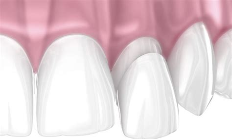Peg Laterals Treatments Firstbite Dental Essendon Dentist