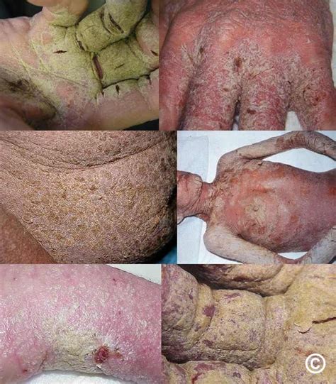 Scabies