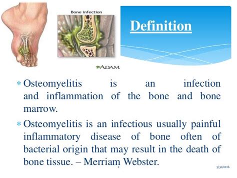 Osteomyelitis