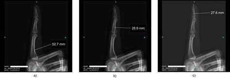 A Proximal Phalanx Length Measured On An X Ray Of The Index Finger B Download Scientific