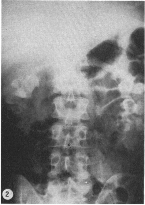 Case 5 Intravenous Pyelogram 2o Minute Film Showing Bilateral