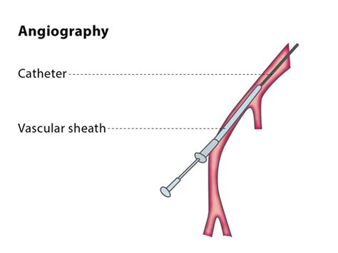 Cirse Innovation Education Intervention