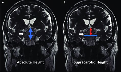 A And B Measurement For The Vertical Compression Representing Download Scientific Diagram