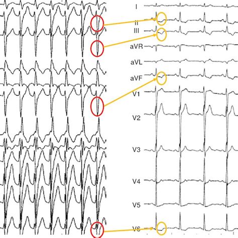 An Example Of Memory Induced T Waves Observed After Radiofrequency