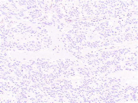 Pathology Outlines Gist