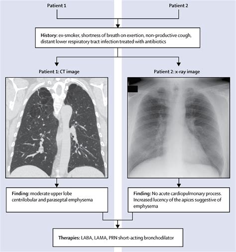copd ct scan findings