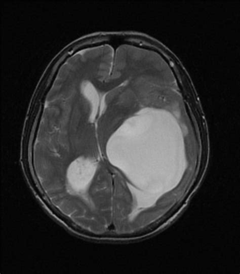 Intraventricular Arachnoid Cysts Pacs