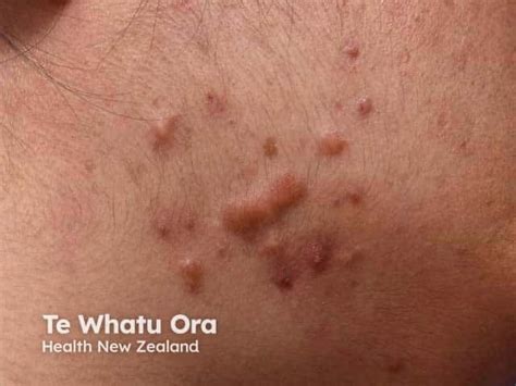 Keloid Keloid Doccheck Flexikon