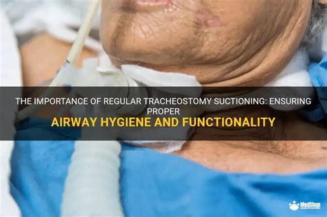The Importance Of Regular Tracheostomy Suctioning Ensuring Proper Airway Hygiene And