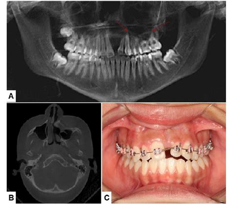 Calcifying Odontogenic Cyst Radiographic
