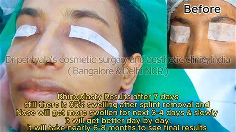 Rhinoplasty 7th Day Splint Removal Before And After Results