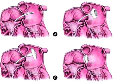 Schematic Of Patent Foramen Ovale Pfo Closure Schematic Illustrating