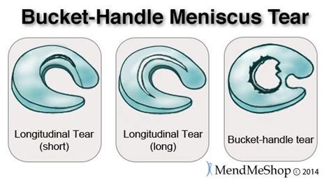 Bucket Handle Tears Are Displaced Vertical Longitudinal Tears And