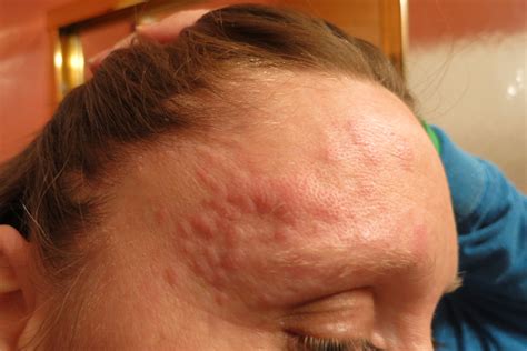 Stress Rash On Forehead