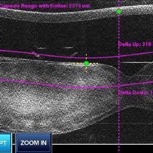 OCT Scan Of The Capsule Showing Grossly Distorted Lens Shape Download Scientific Diagram