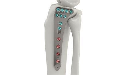 Tyber Medical Gains Fda Clearance For Proximal Tibia Plating Orthoworld Tyber Medical Gains Fda Clearance For Proximal Tibia Plating Orthoworld