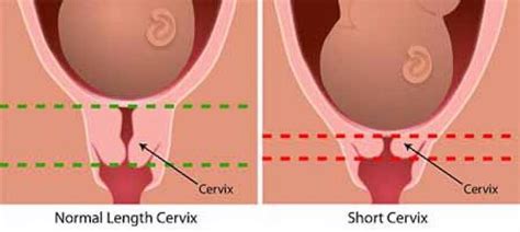 Cervix Early Pregnancy