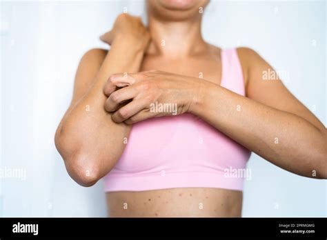 Eczema On Chest Women