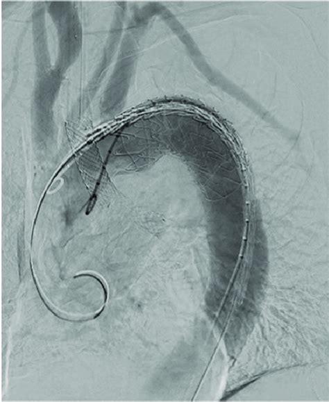 Completion Angiography After Tevar Download Scientific Diagram