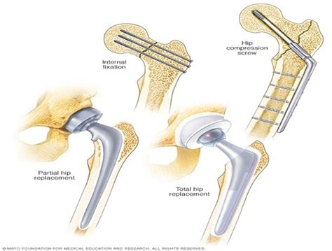 Hip Socket Fracture