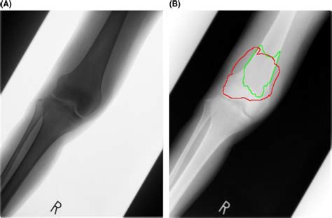 High‐quality Expert Annotations Enhance Artificial Intelligence Model Accuracy For Osteosarcoma