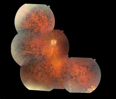 Cobblestone Degeneration