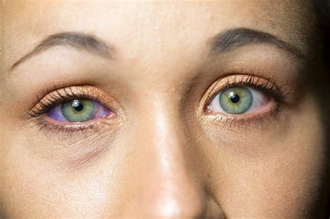 Purple Tears From Purple Sclera Catt Gallinger Example Medizzy Journal