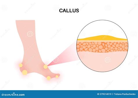 Plantar Hyperhidrosis Poster Vector Illustration