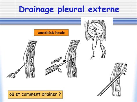 Ppt Le Drainage Pleural Powerpoint Presentation Free Download Id