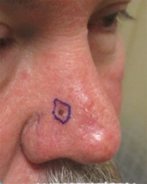 Nose Acms American College Of Mohs Surgery