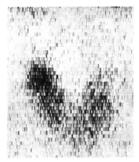 Rectilinear Thyroid Scan Demonstrates Hyperfunctioning Nodule In Upper Download Scientific