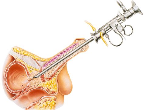 Bph Surgery Risks Complications And Recovery
