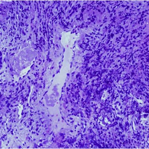 Histopathological Findings Of The Subglottic Lesion Biopsy Specimen