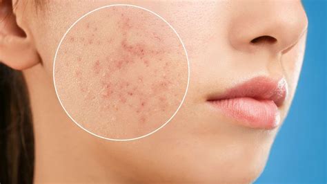How To Get Rid Of Hyperpigmentation From Acne Complete Guide