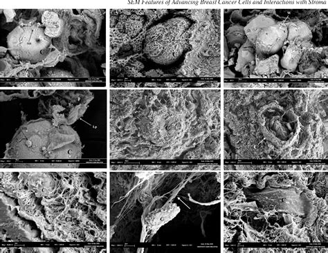 Cancer Cells Under Electron Microscope