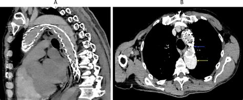 A Compression Of The Amds At The Isthmus In One Patient B Yellow Download Scientific Diagram
