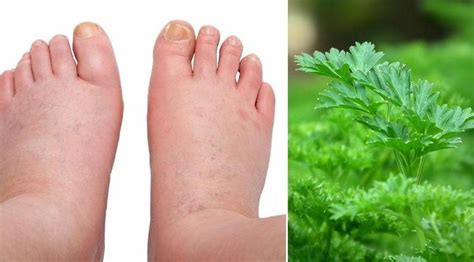 რა იწვევს წყლის შეკავებას და შეშუპებას 5 ნატურალური საშუალება რომელიც პრობლემას სწრაფად