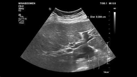 Physiologic Dilated Biliary Youtube