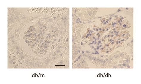 glomerular hypertrophy with endothelial cell proliferation in db db