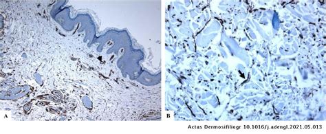 Immunohistological Analysis Of Cd34 Positive Dermal Dendritic Cells And Microvessel Density In