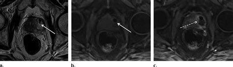 Prostatic Abscess In A 60 Year Old Man Following Transrectal Prostate