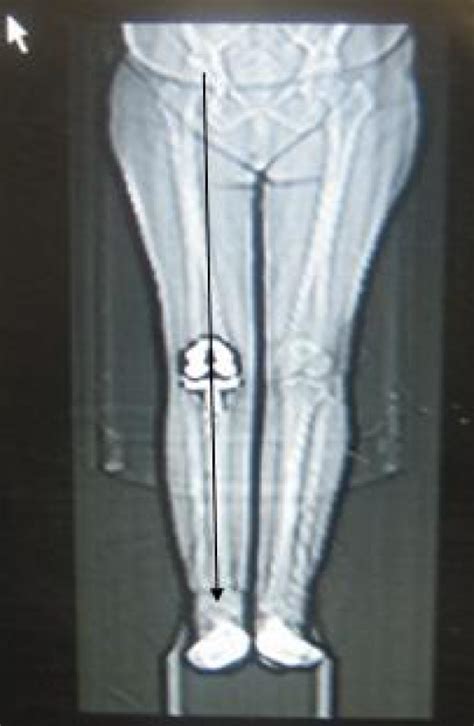 CT Scanogram For Limb Length Discrepancy In Comminuted OFF