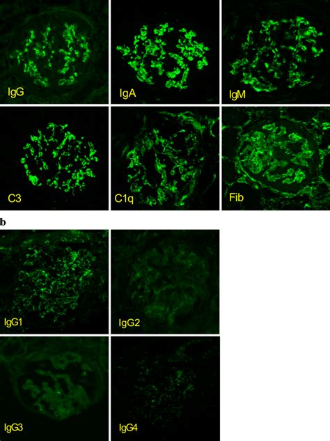 Figure2 A Immunofluorescent Microscopy Showed Granular Deposition Of Download Scientific