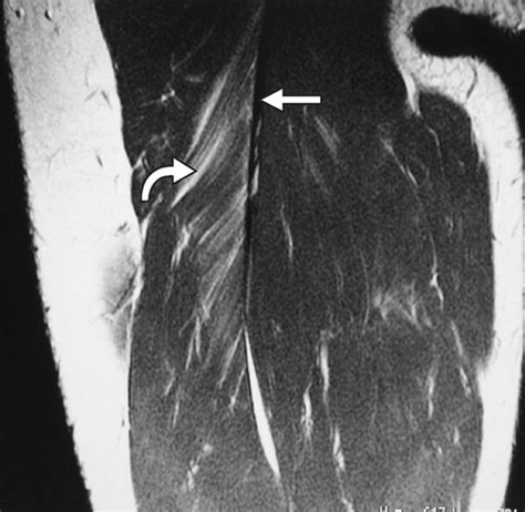 Hamstring Muscle Complex An Imaging Review Radiographics