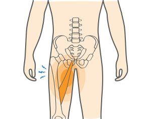 Groin Pain After Running Causes Treatments Prevention Marathoners