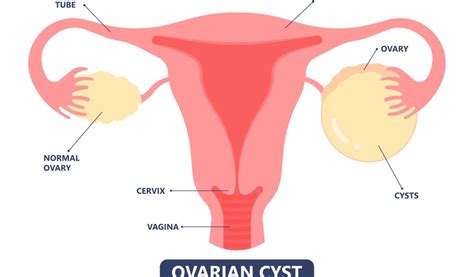 Everything You Need To Know About Ovarian Cysts Causes Diagnosis And