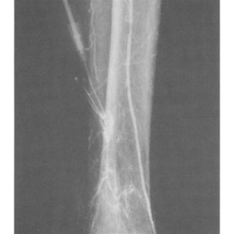 Ioa Via The Distal Peroneal Artery Note Poor Filling Of The Pedal